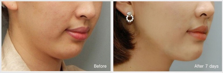 Beauty Secrets: V-shaped Face without the Blade - SKIN Magazine