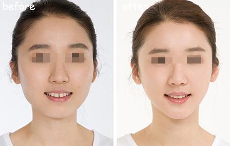 Beauty Secrets: V-shaped Face without the Blade - SKIN Magazine