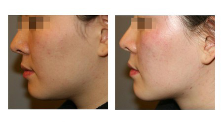 How To Get Rid of Your Turkey Neck Without Surgery - SKIN Magazine