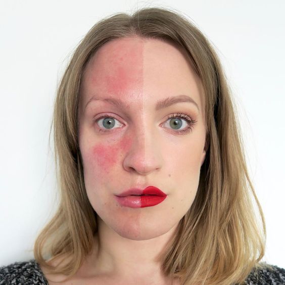 Complexion Fighters: IPL or VBeam For Redness? - SKIN Magazine