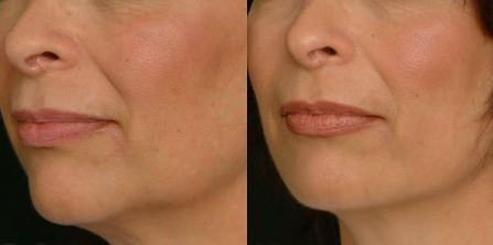 Pretty Poison - All The Ways Botox Can Help With Your Jawline - SKIN ...