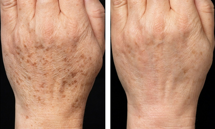 The Best Treatments For Younger-Looking Hands - SKIN Magazine